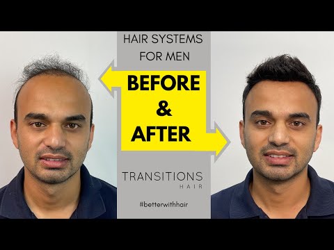 Watch This! Before & After - Non-Surgical Hair Systems for Men - Sydney Australia - UK / USA