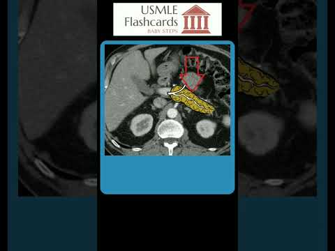 Chronic pancreatitis #usmle #gastrointestinal