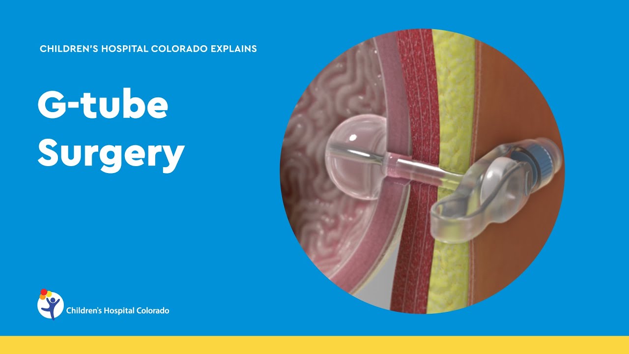 G-tube Surgery