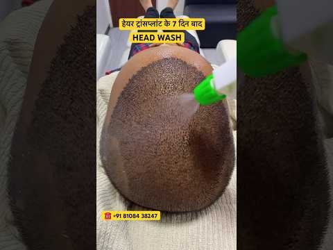 Head Wash After Hair Transplant #hair #hairtransplant #ytshorts #shorts