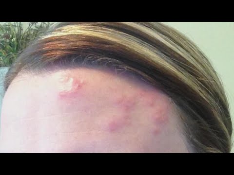 Who should get vaccinated against shingles | FOX 5 News