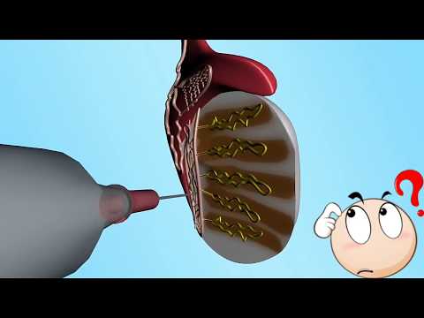PESA, MESA, TESA, TESE - Sperm Retrieval Techniques Female First Hospital
