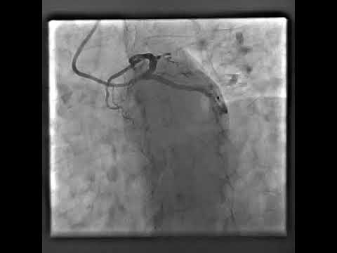 OSTIAL LMCA Stenosis.