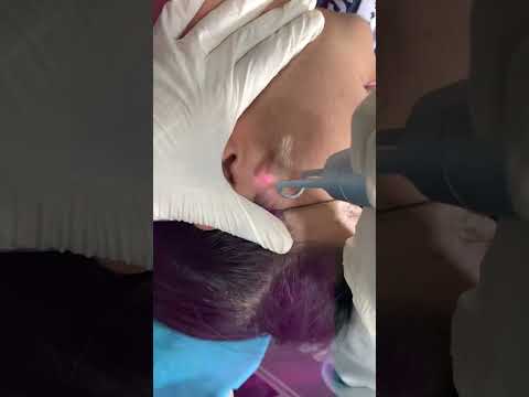 ????Discover Radiant Skin! ✨ Q-Switch Laser for Skin Whitening & Fine Hair! ???? | Skinaa Clinic #viral