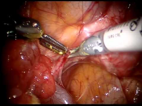 Robotic Lysis of Adhesion and Excision of Endometrosis