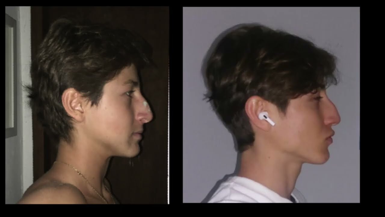 2.5 YEARS CRAZY MEWING TRANSFORMATION !