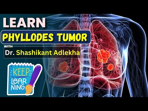 Phyllodes Tumor|What are the signs of phyllodes tumor of the breast? usmle,neetpg,plab,fmge