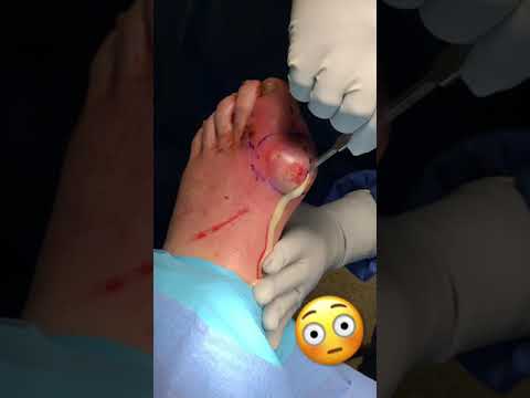 DRAINING A SEVERE TOE INFECTION! “TOE” POPPING! #shorts #pimplepopping