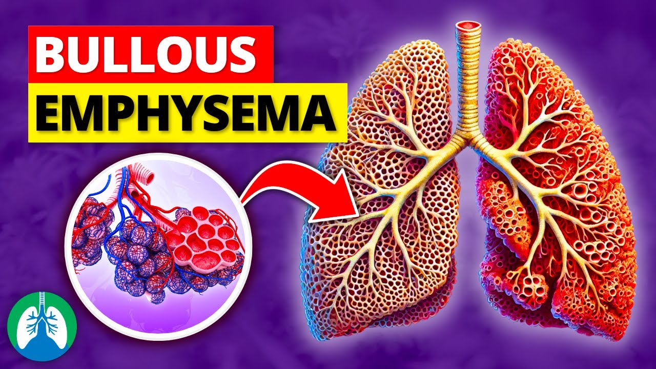 Bullous Emphysema | Quick Explainer Video
