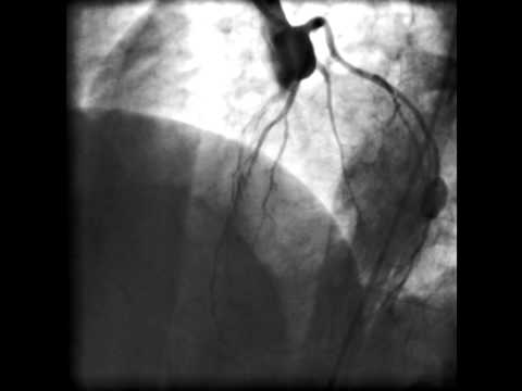 62 L main LAO cranial