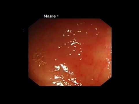 #terminal #ileum #intubation