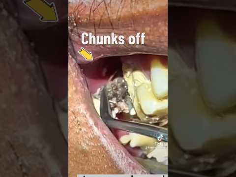 Giant dental Calculus