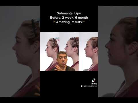 Chin Lipo result!