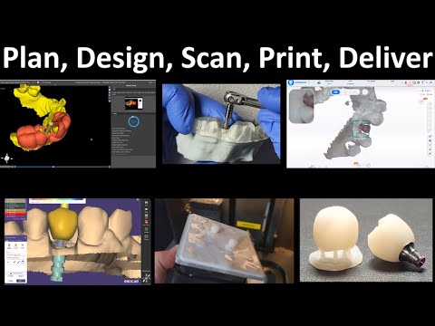 From Implant Planning to Delivering the Final Restoration - Full Workflow