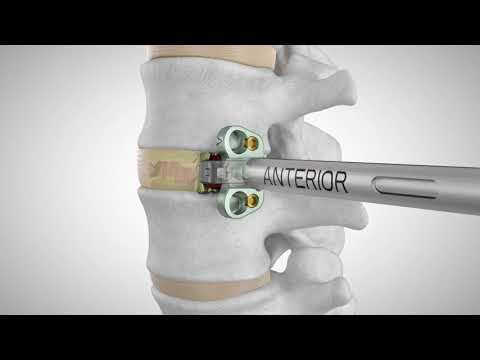 Globus Medical: ADIRA™ XLIF™ Plate System
