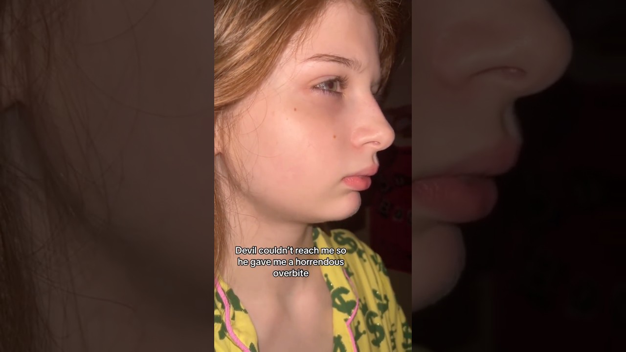 Overjet Explained and How We Fix It!