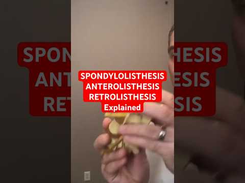 What Is Spondylolisthesis? Anterolisthesis? Retrolisthesis? (Everything You Need To Know)