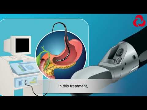 ERCP Minimally Invasive Procedure for Gastrointestinal illnesses
