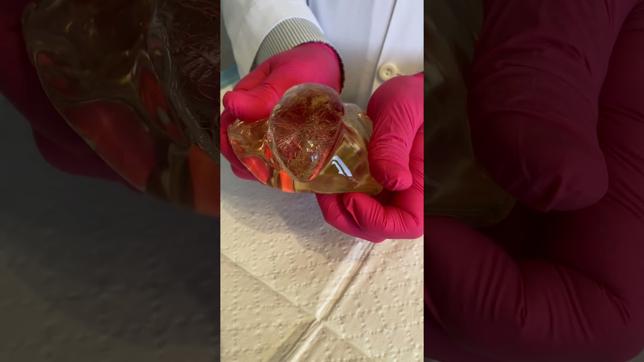 How Strong is a Breast Implant? Watch Dr. Doherty Cut Open a Breast Implant & Discuss the Results