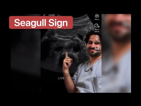 Seagull Sign (Celiac Artery and Branches)