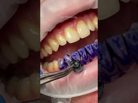 Air polishing plaque removal #shorts