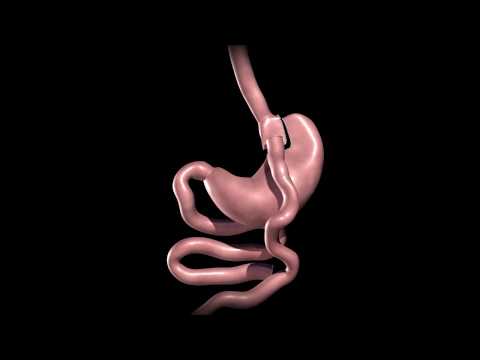 Roux-En-Y Gastric Bypass