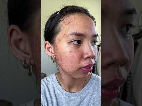 acne journey ???????? #shorts #acne #acnejourney #acneproneskin #acnetreatment