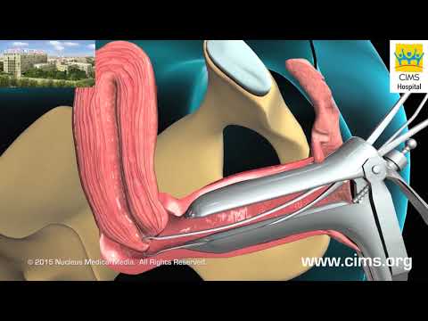Endometrial Biopsy - CIMS Hospital