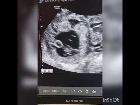 ectopic pregnancy
