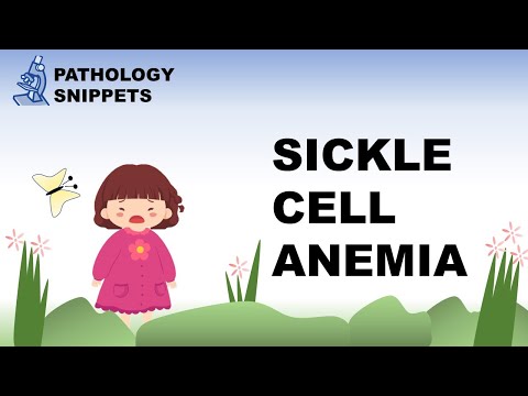 Sickle cell anemia