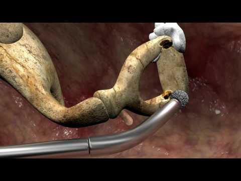 Stapedotomy surgery for Otosclerosis