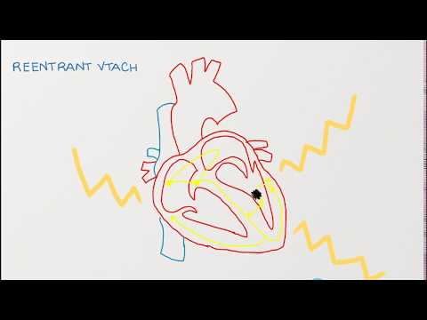 Ventricular Tachycardia - Types, Causes, and Treatment Approaches