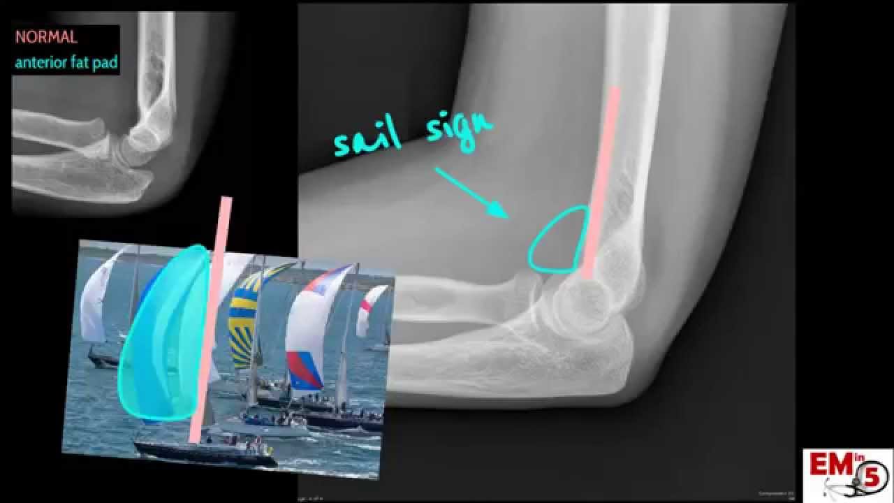 Elbow Xray Interpretation