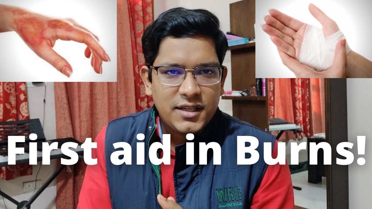 First Aid in Burns | Doctor’s Advice