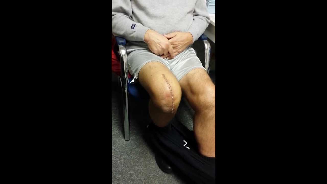 2 weeks after knee replacement by Dr Robert Lupo