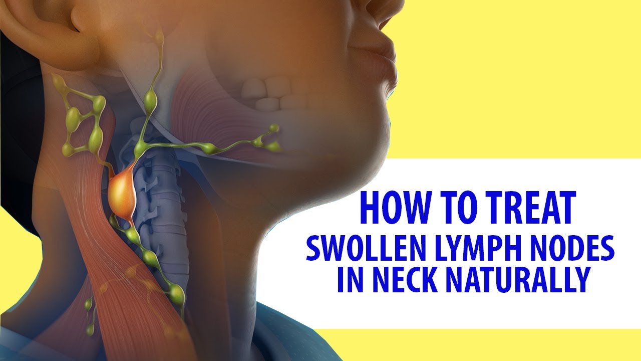 Quick and Easy Home Cure for Swollen Lymph Nodes #nodes