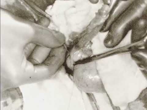 An Operation For Appendicitis