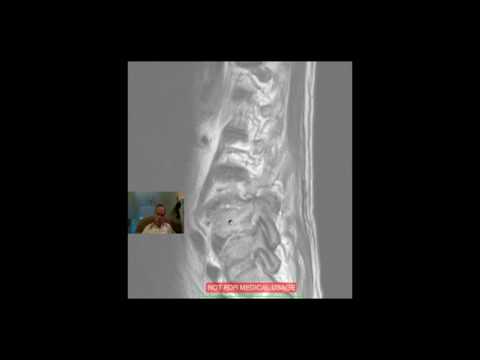 MRI Lumbar Spine Severe degeneration