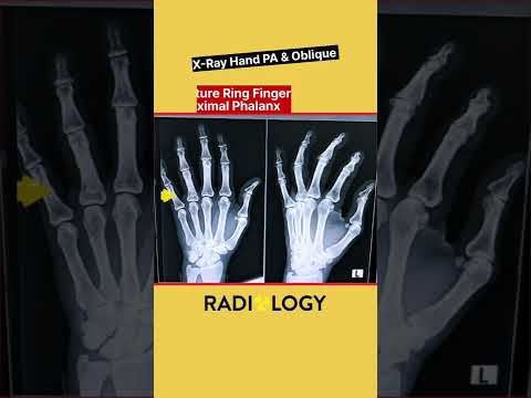 Fracture Ring Finger Proximal Phalanx | X-Ray Hand #shorts #ytshort