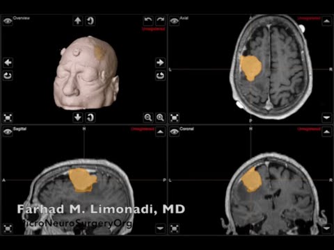 Operacja neurochirurgiczna - usunięcie wielkiego oponiaka mózgu • Film ...