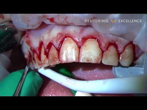 Crown Lengthening with Dr Lincoln Harris