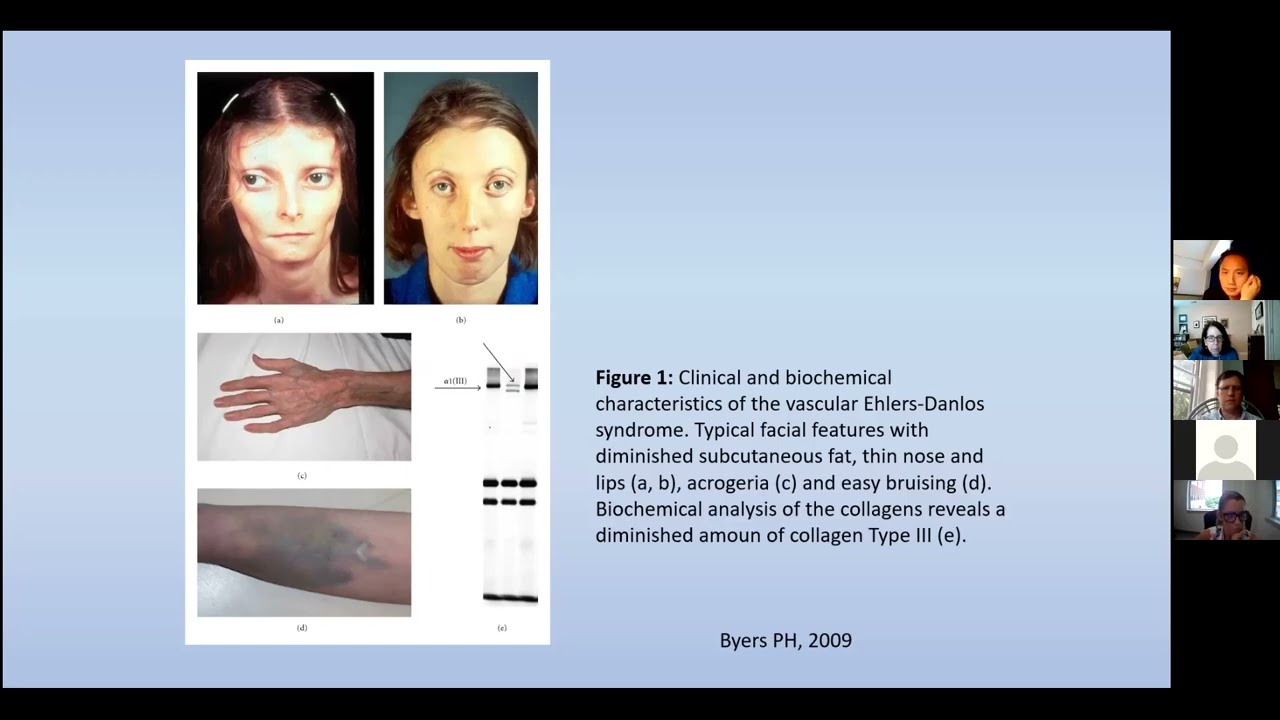 Ehlers-Danlos Syndromes and Hypermobile Spectrum Disorders