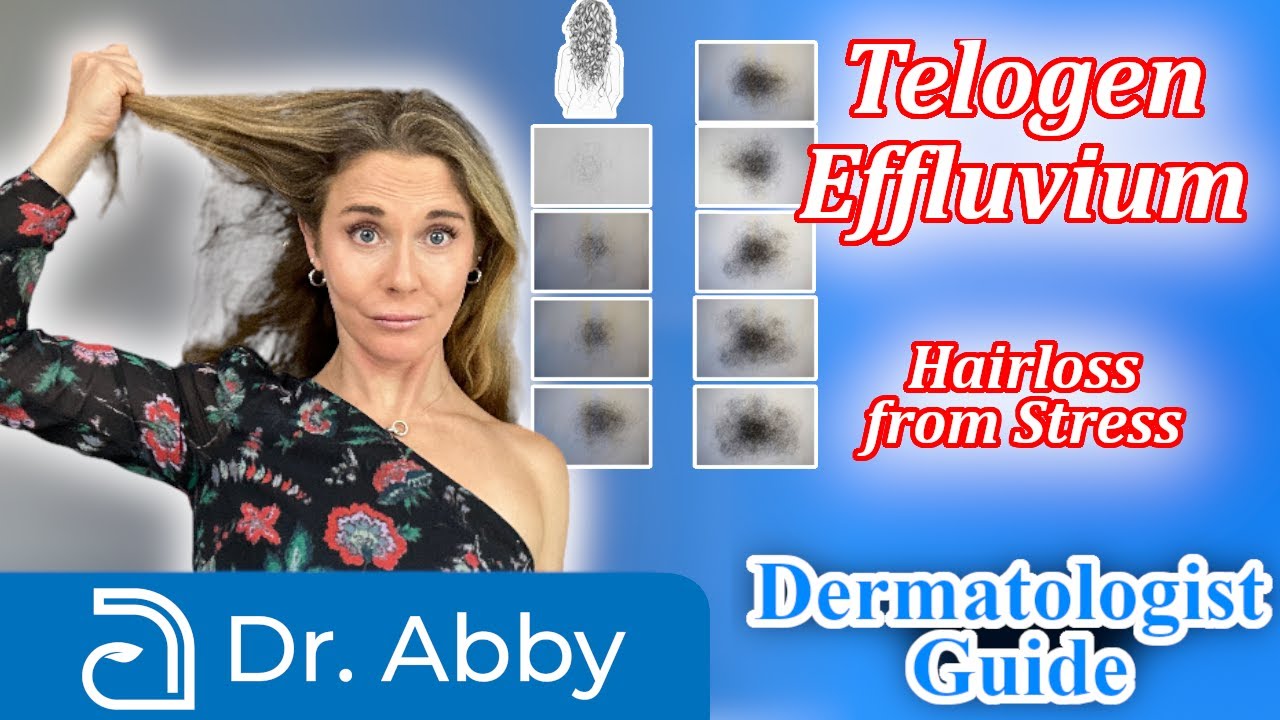 Telogen Effluvium: Dermatologist guide to this common type of hair loss
