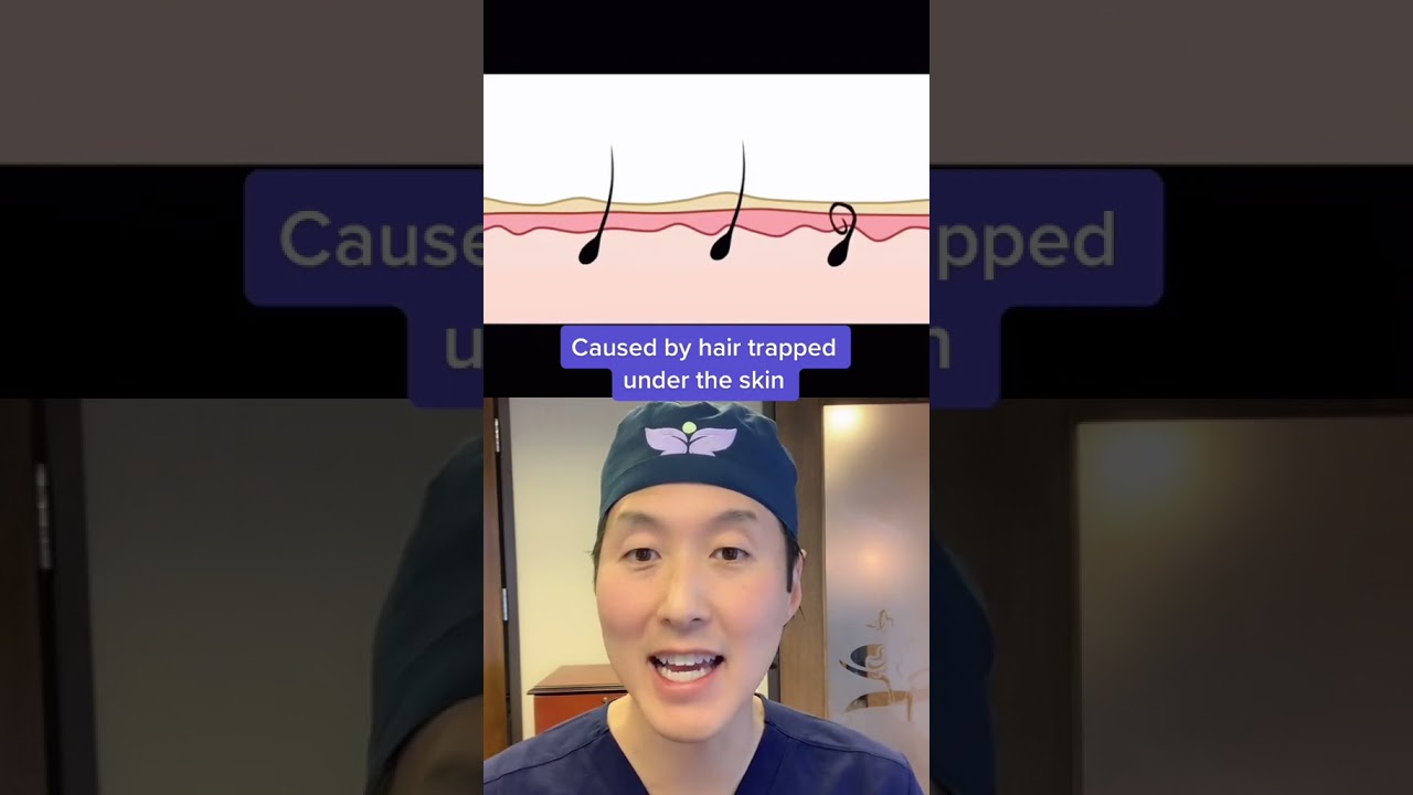 How to Prevent & Treat Ingrown Hairs! #shorts #ingrownhair