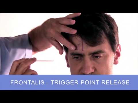 Dry Needling Medical Acupuncture for Trigger Point Release – Frontalis ...