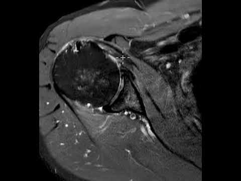 Coracoid impingment and subscapularis tendon tear