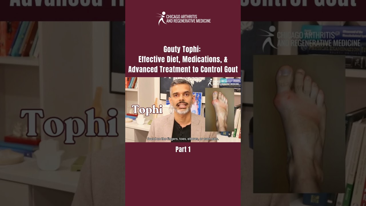 Gouty Tophi Effective Diet, Medications, and Advanced Treatments to Control Gout | PART 1