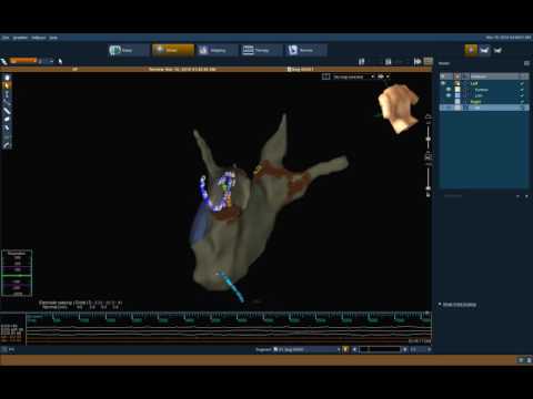 PVI 3D mapping
