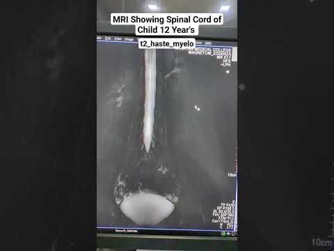MRI t2_haste_myelo Sequence Planning Shows Myelogram #beginners #anatomy