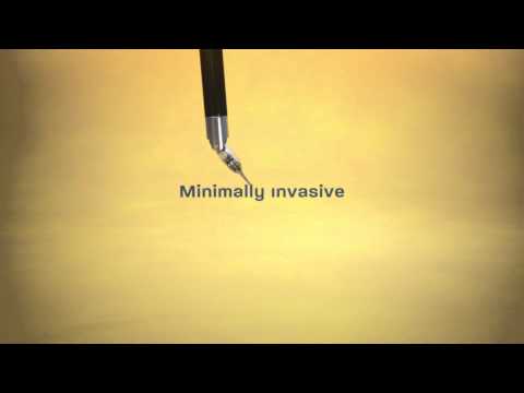 daVinci® Robot Assisted Surgery | Middlesex Hospital
